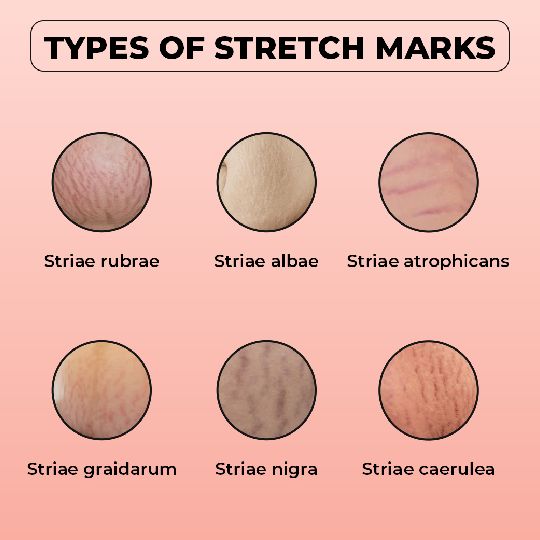Stretch Marks Treatment in Hyderabad | Stretch Marks Removal Stretch Marks Treatment in Hyderabad | Stretch Marks Removal